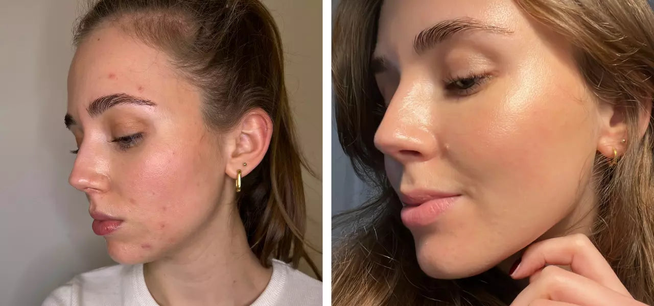 Hautgeschichten: Celina erzählt, wie sie ihre Akne in den Griff bekomm ...